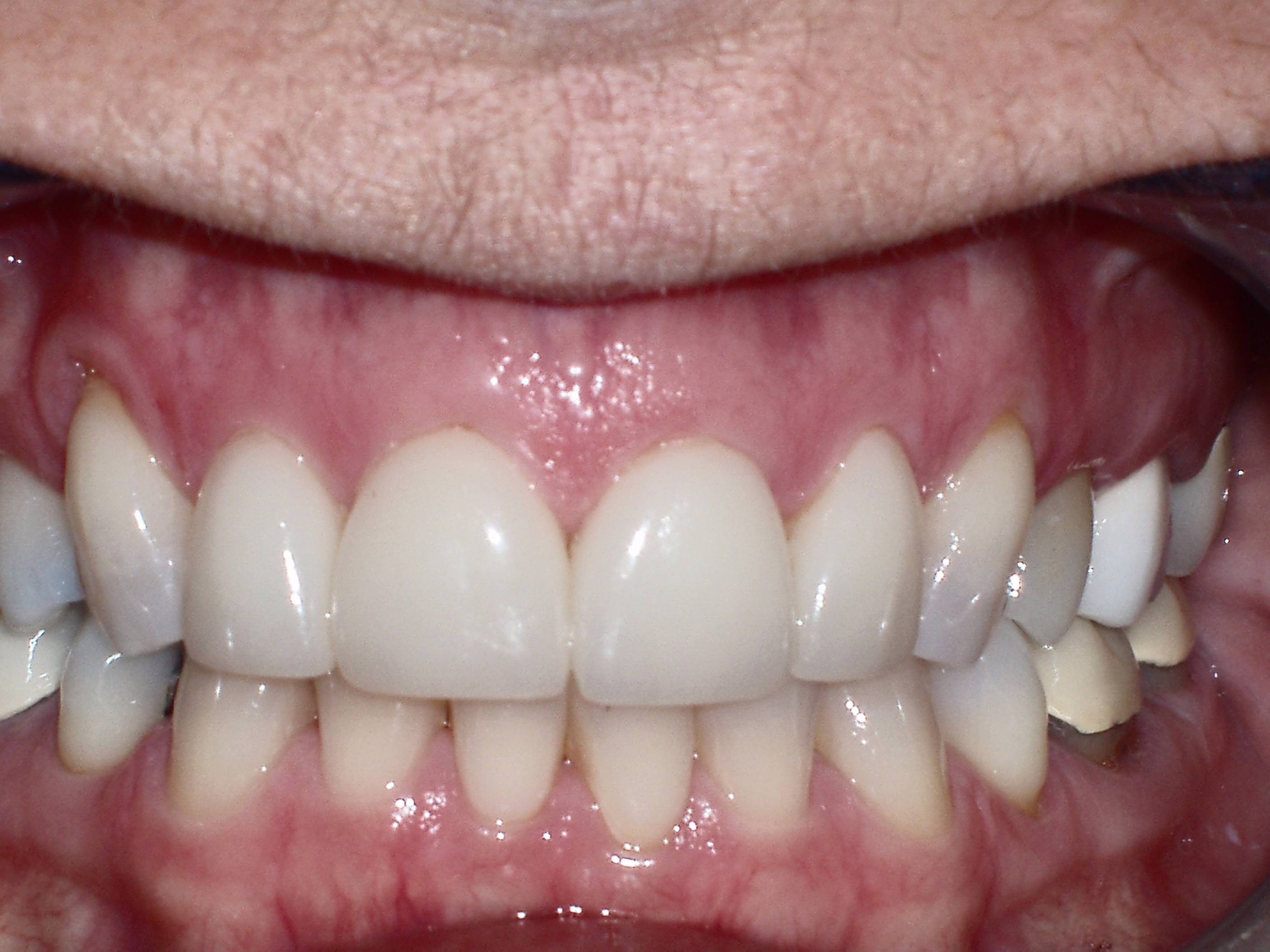 jaime after | First Impression Dentistry