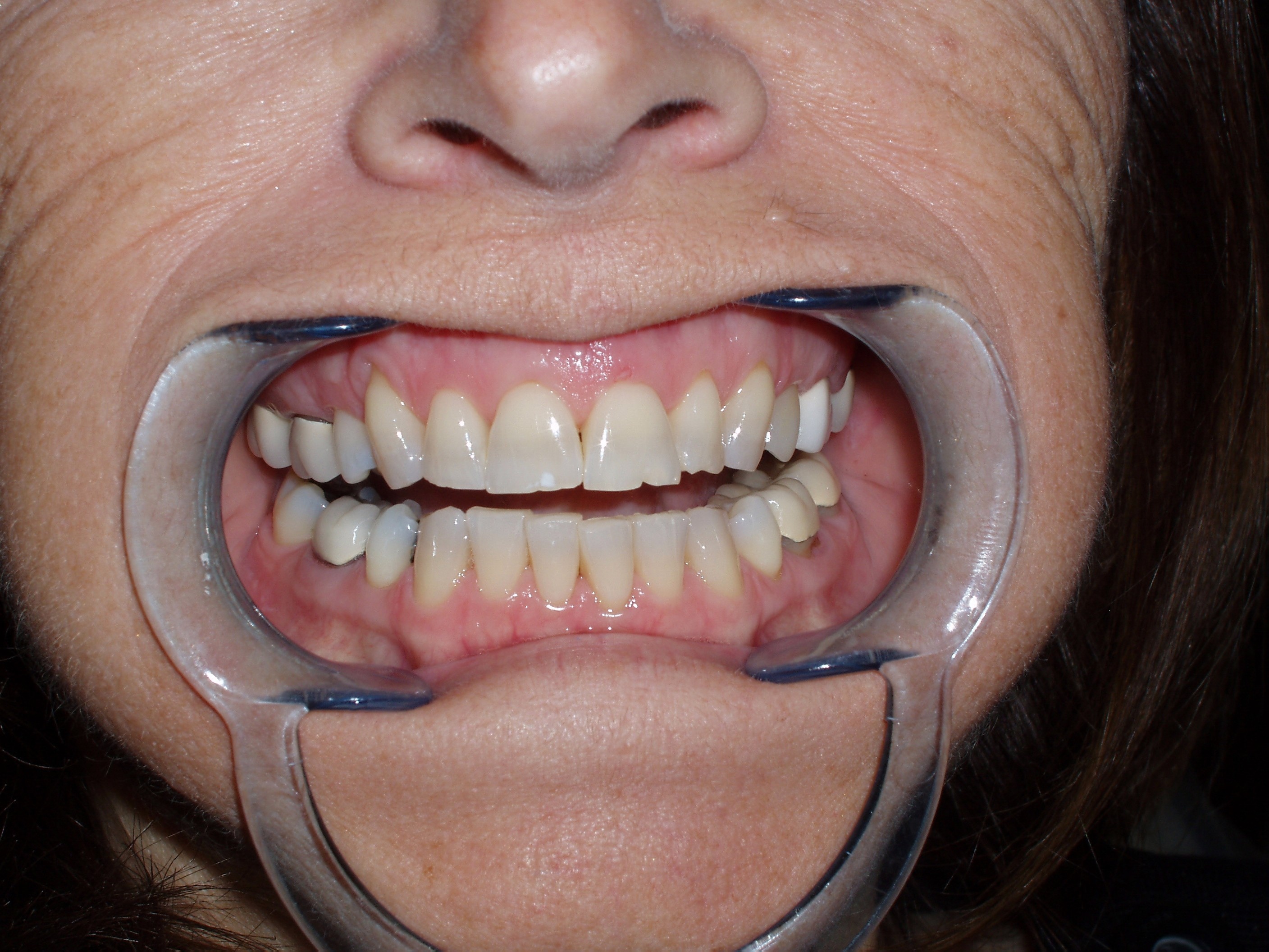 jaime before | First Impression Dentistry